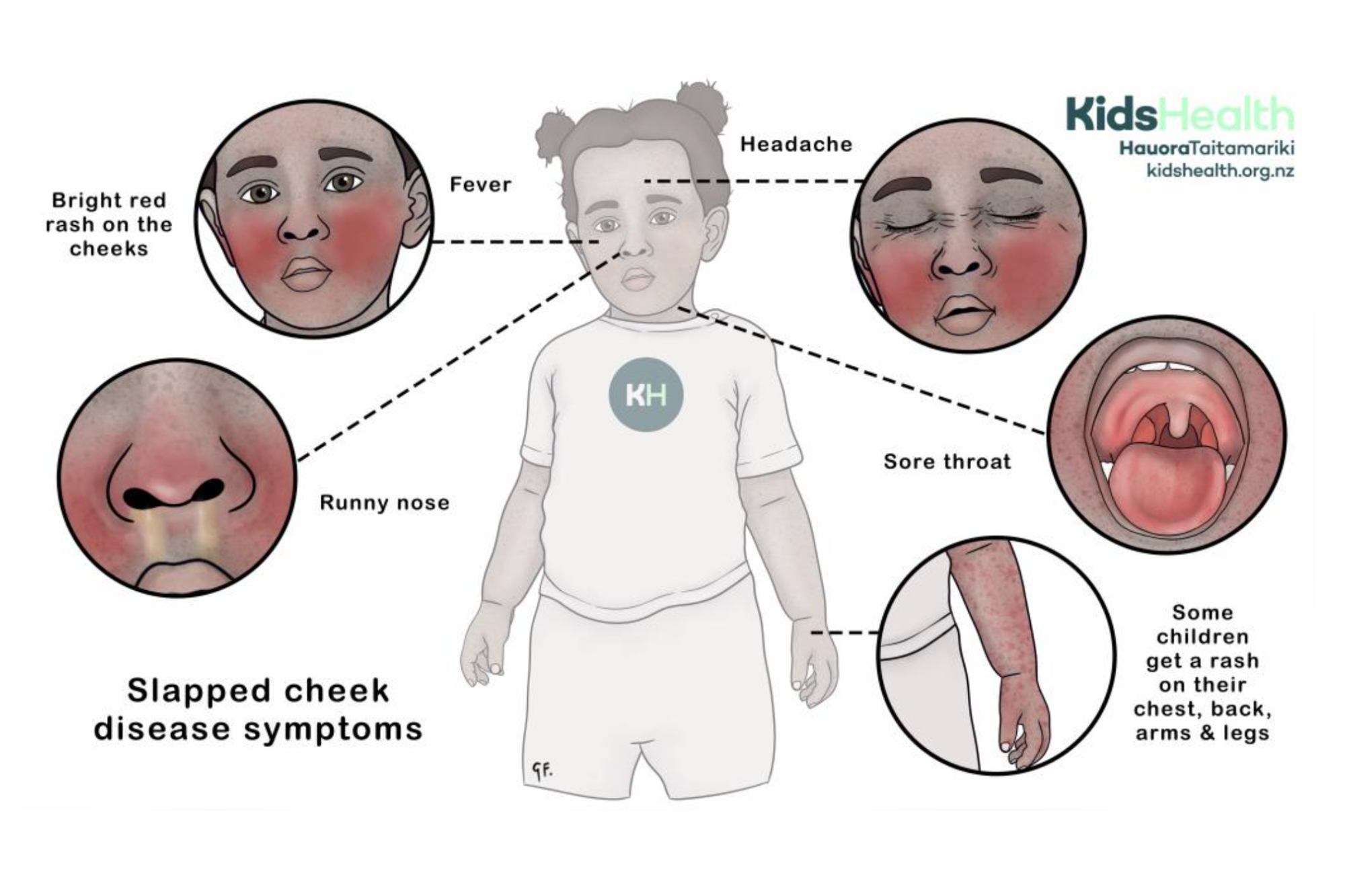 New KidsHealth Resource: Slapped Cheek Disease (fifth disease) | The ...